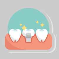 Prothese Zahn: Lückenschluss mit Zahnbrücke oder Implantat mit Krone