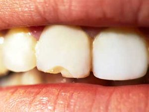 abgebrochener Zahn: Abgebrochene Zähne sind schnell wieder hergestellt